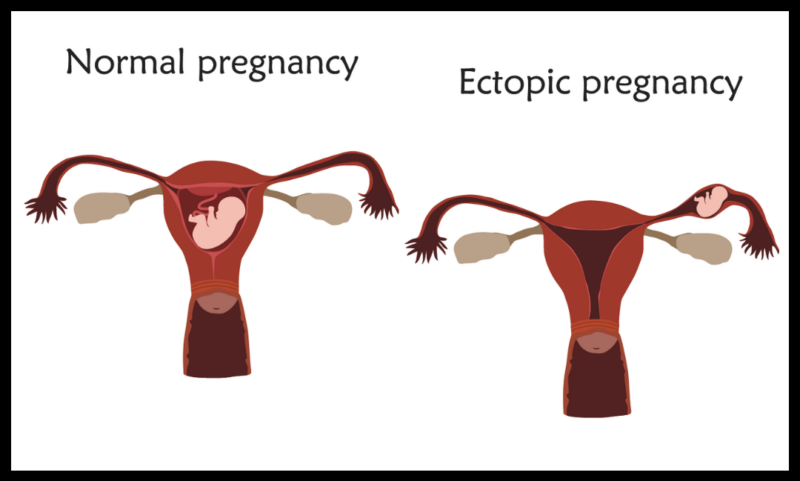 Management of Ectopic Pregnancy – Ganin IVF